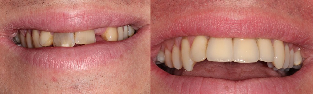 Losing front teeth is really traumatic. Having them back is such a ...