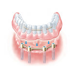 retention-bars | Ten Implant Centre